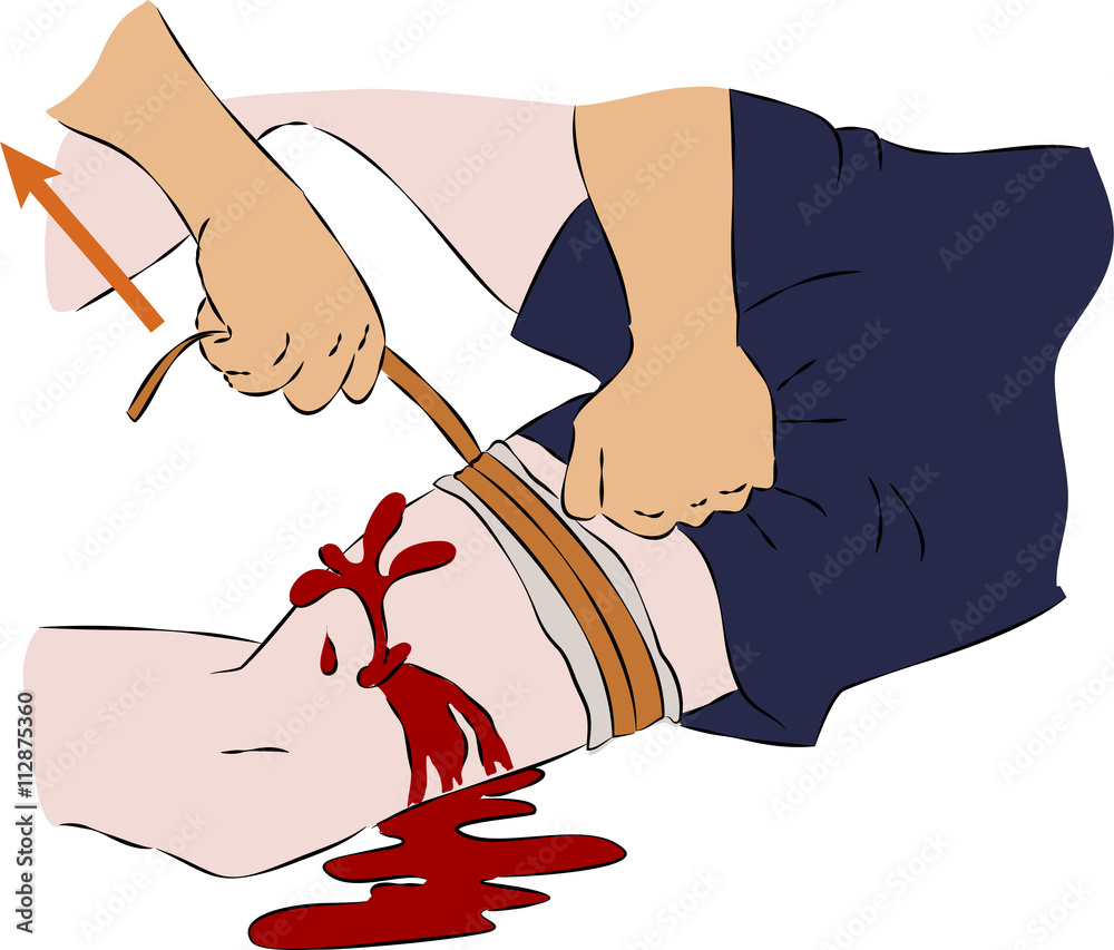 Poster First help - stop blood on leg with rubber band – Wall Art ...