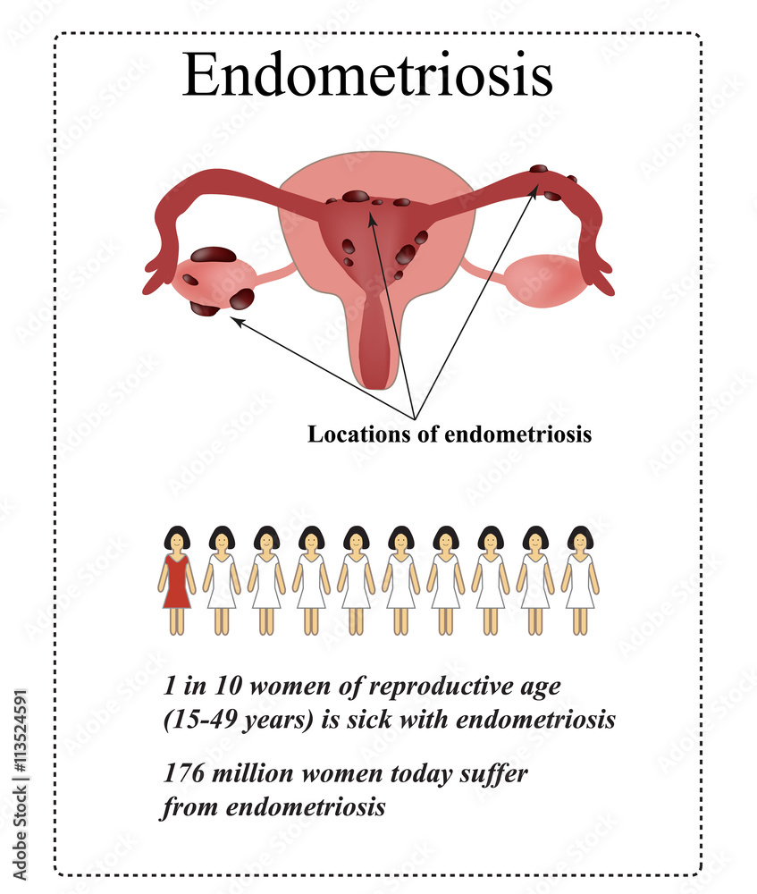 Endometriosis. Endometrial cysts. The endometrium. Statistics ...