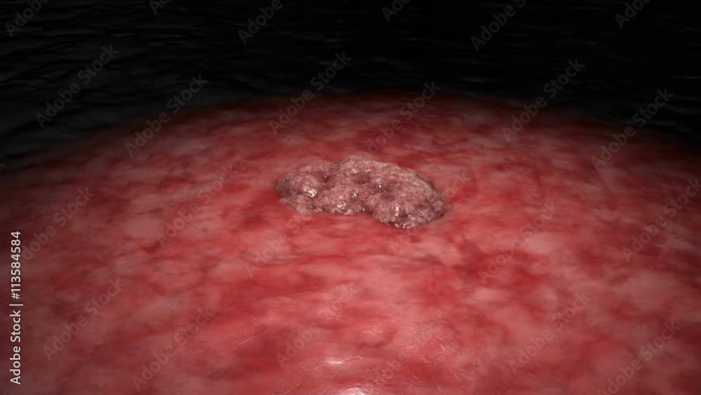 Cancer cell growth animation. Tumor growing over tissue Stock Video ...