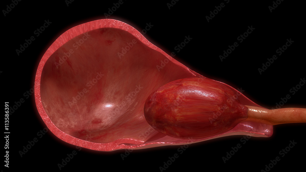 Pulling placenta out of uterus Stock Illustration | Adobe Stock