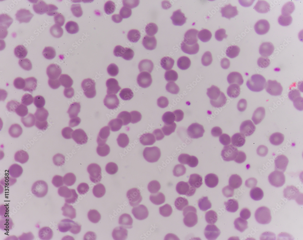 abnormal red blood cells Stock Photo | Adobe Stock