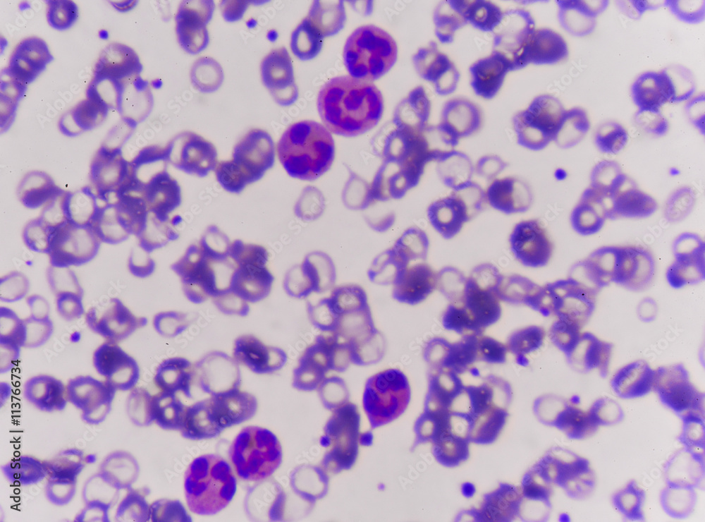 Neutrophil cell (white blood cell) in peripheral blood smear, Wr Stock ...