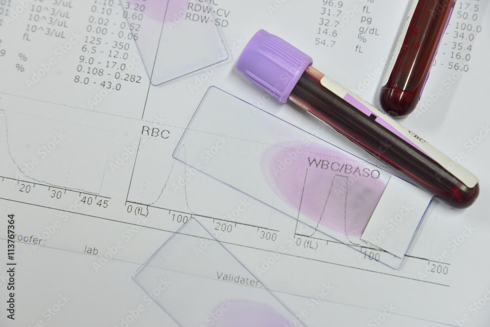 Blood test for Complete Blood Count. CBC Stock Photo | Adobe Stock