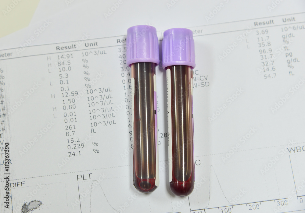 Blood test for Complete Blood Count. CBC Stock Photo | Adobe Stock