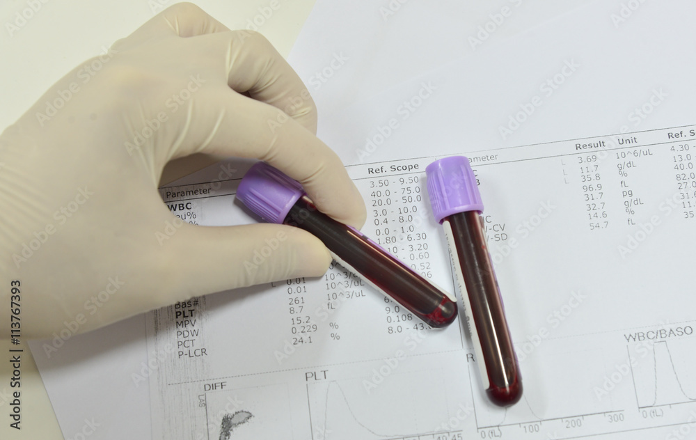 Blood test for Complete Blood Count. CBC Stock Photo | Adobe Stock