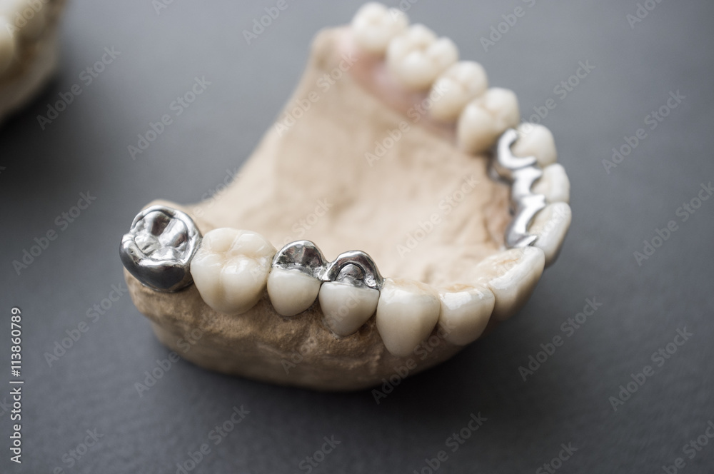 Human jaw layout with ceramic and metal dentures. Front view on plaster ...