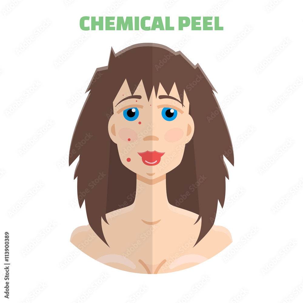 Cosmetic peeling. Chemical peeling before & after Stock Vector | Adobe ...