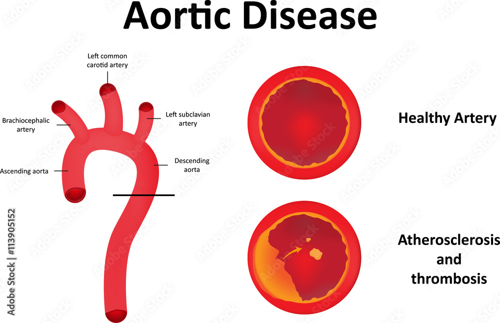 Aortic Disease Diagram Stock Vector | Adobe Stock
