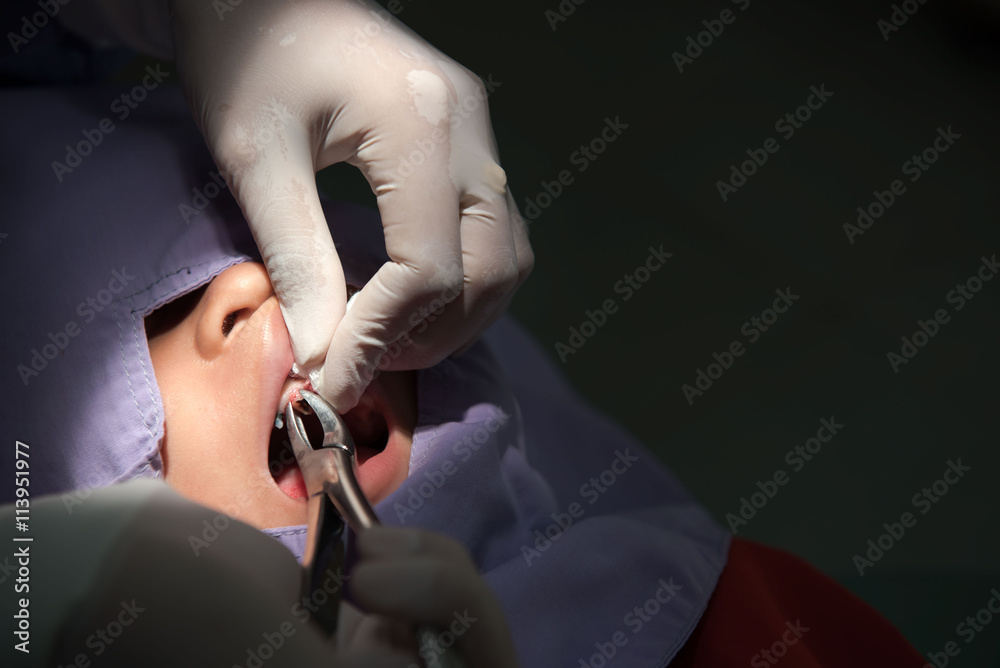 Caries tooth extraction by the dentist. Dentistry in hospital Stock ...