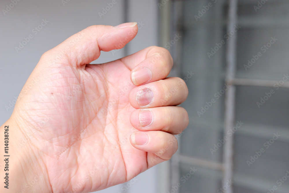 Fungus Infection on Nails Hand, Finger with onychomycosis. - soft focus ...