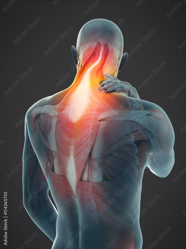 medically accurate 3d illustration of neck pain Stock Illustration ...