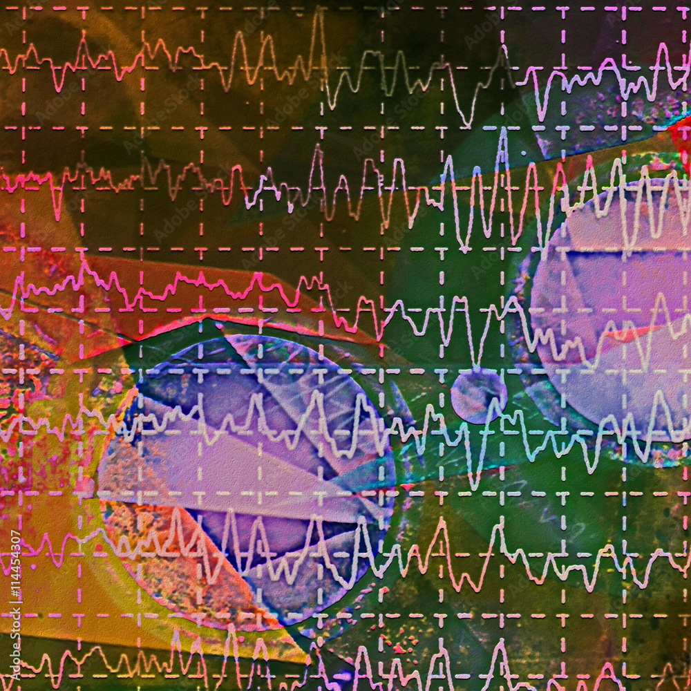 brain wave on electroencephalogram EEG for epilepsy, illustration ...