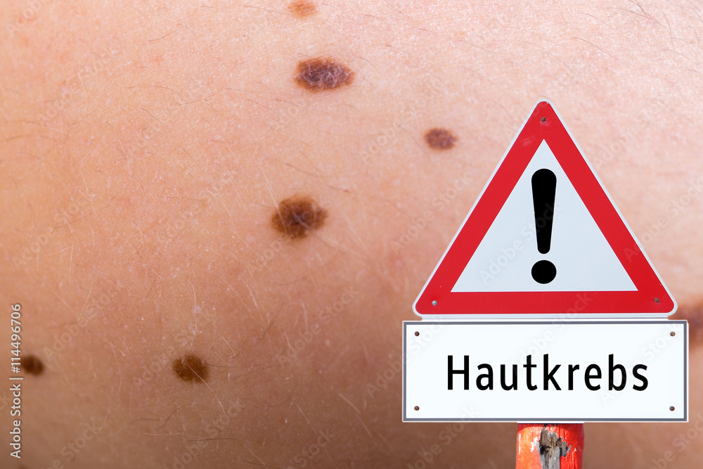 Warnschild Hautkrebs Stock Photo | Adobe Stock