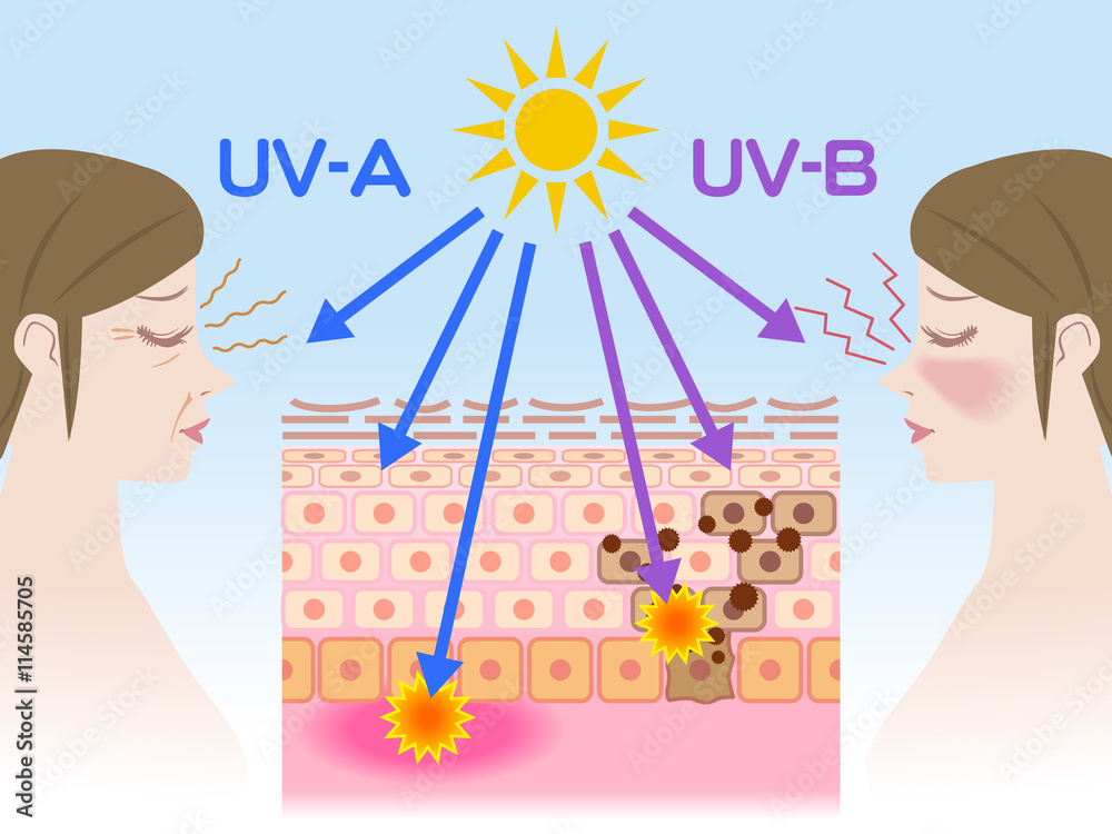 mechanism of sunburn and aging of the skin Stock Vector | Adobe Stock
