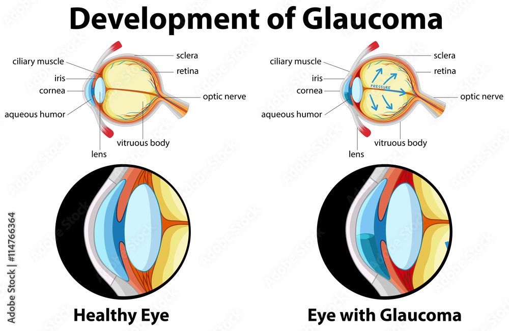 Diagram showing development of glaucoma Stock Vector | Adobe Stock