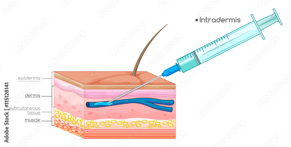 Diagram showing needle injection on skin Stock Vector | Adobe Stock