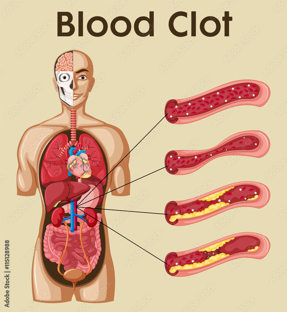 Diagram showing blood clot in human Stock Vector | Adobe Stock