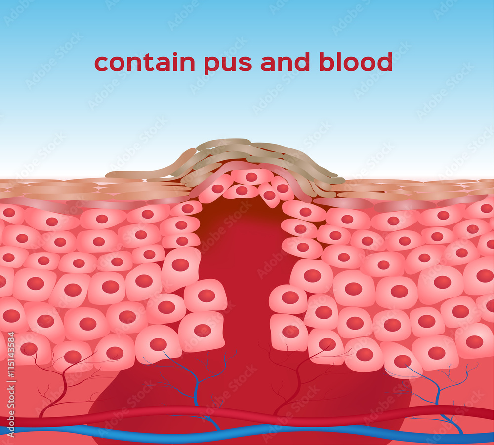 bruised , wound skin vector graphic . the blood almost come out of ...