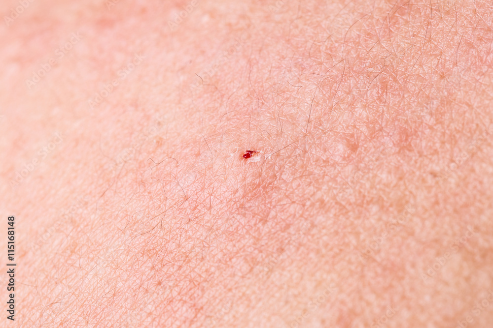 eczema atopic dermatitis symptom skin,cause of itchy scar detail Stock ...