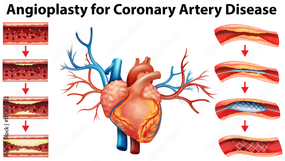Diagram showing angioplasty for coronary artery disease Stock Vector ...