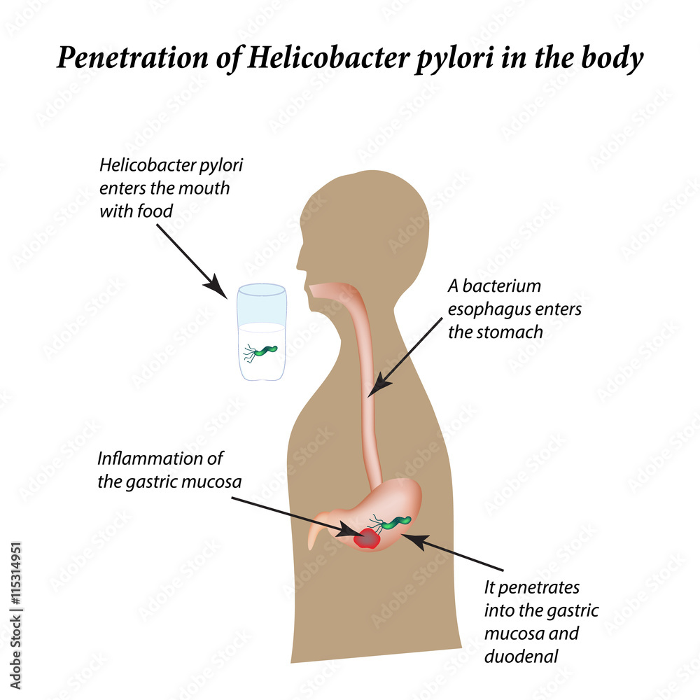 Infection with Helicobacter pylori. Infographics. Vector illustration ...