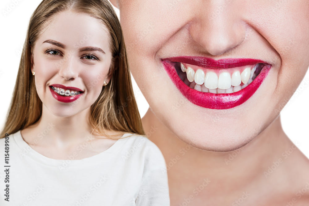 Perfect teeth before and after braces Stock Photo | Adobe Stock