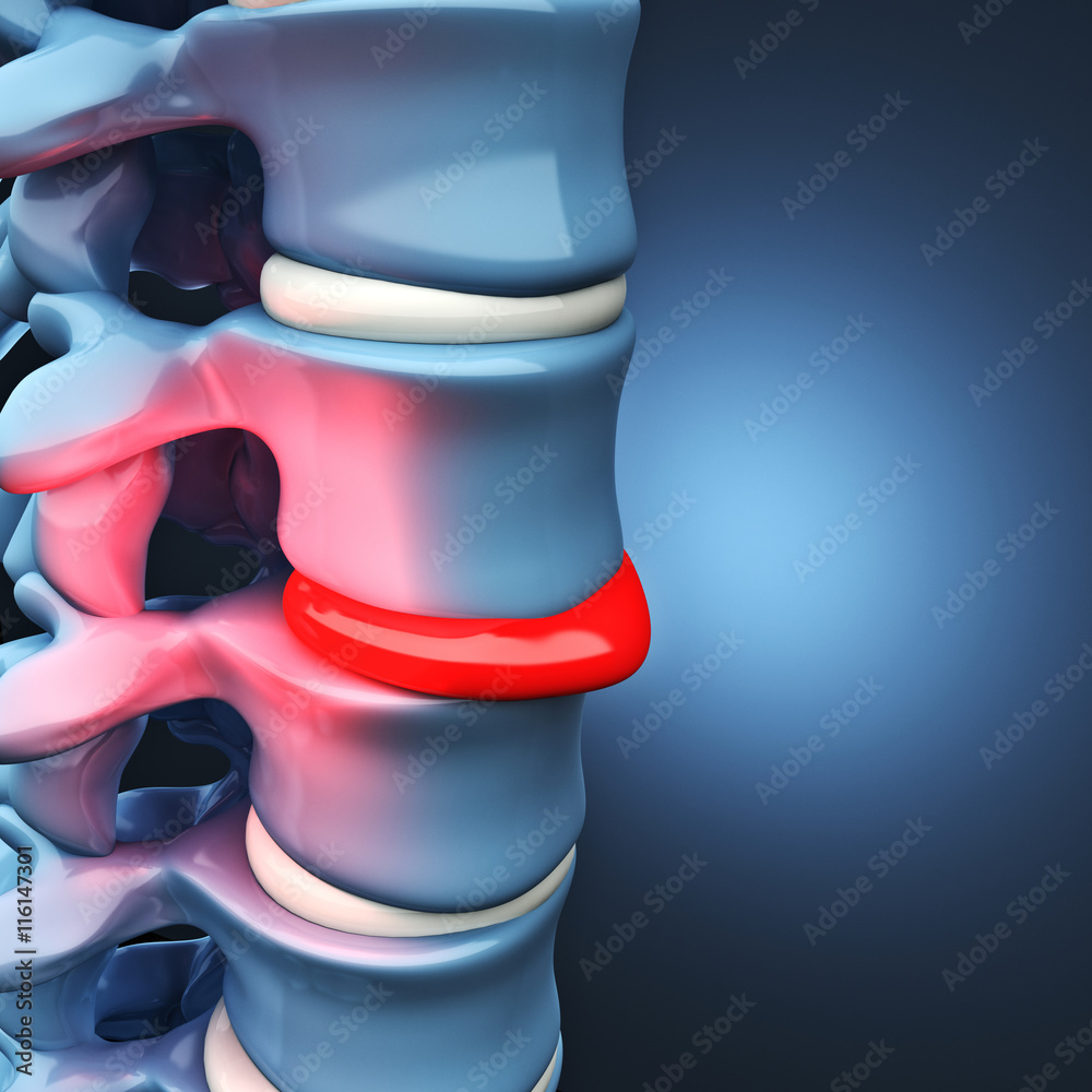 3d image of a blue spine with red areas indicating health problems ...