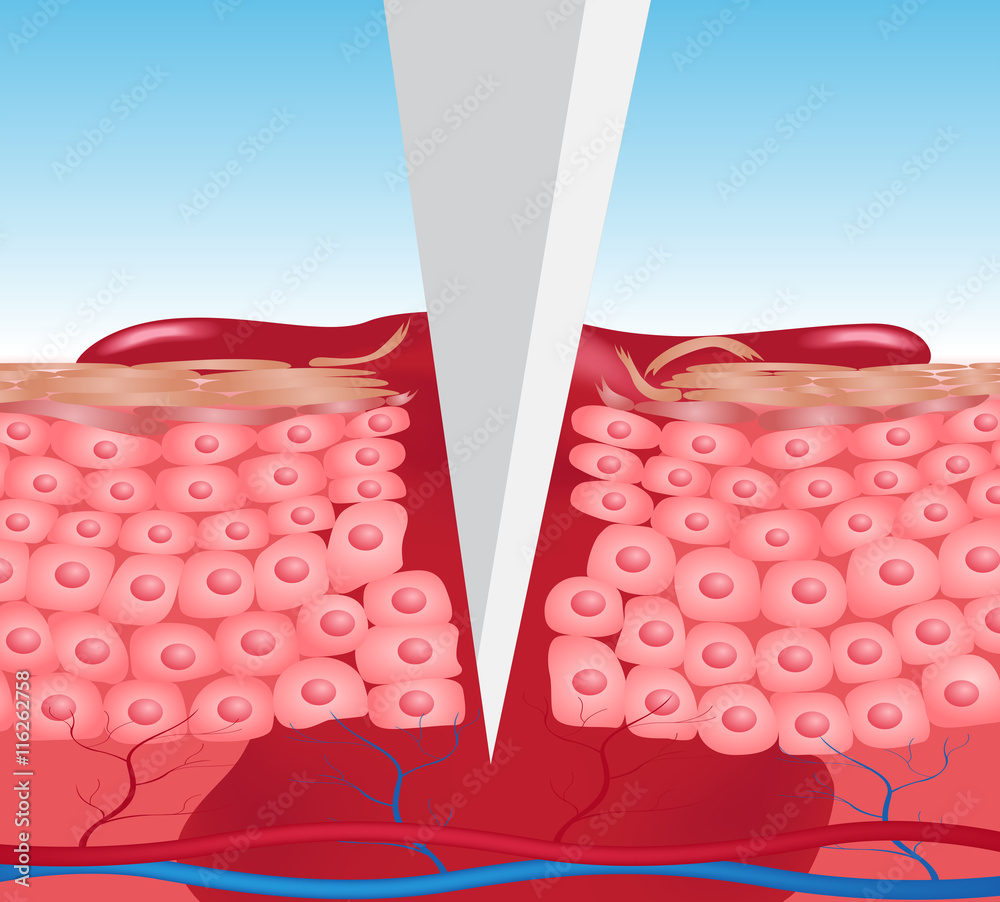 wound skin vector graphic . blood come out of wound Stock Illustration ...