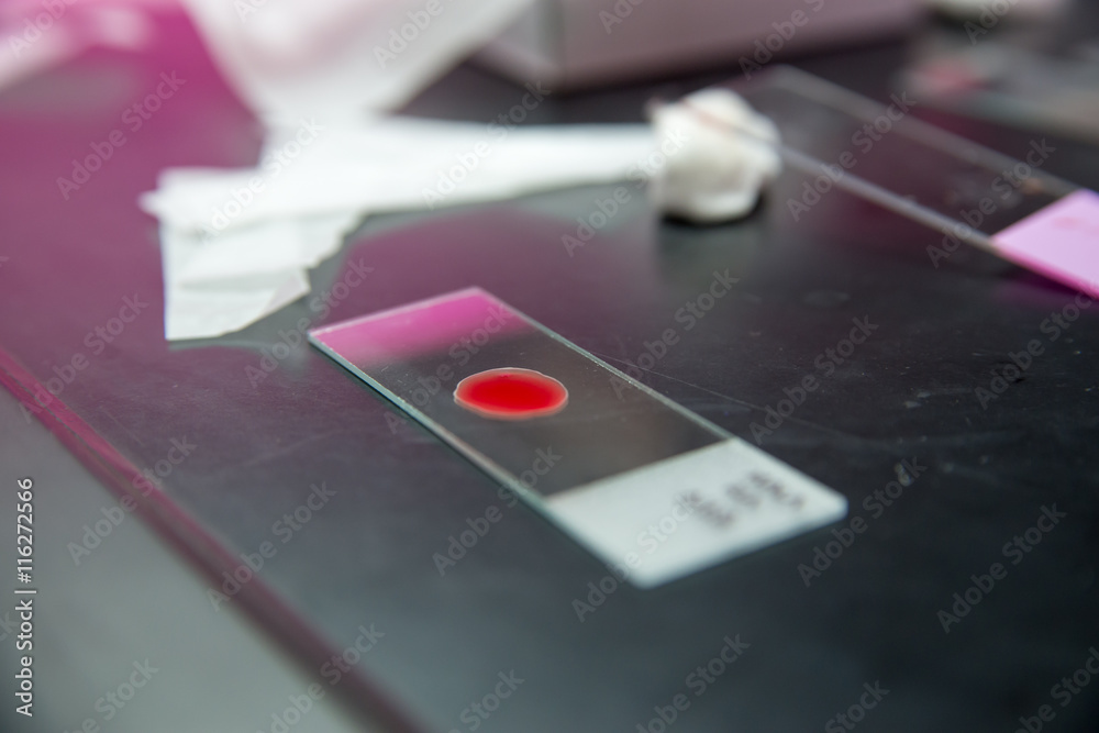 Blood sample on microscope slide Stock Photo | Adobe Stock