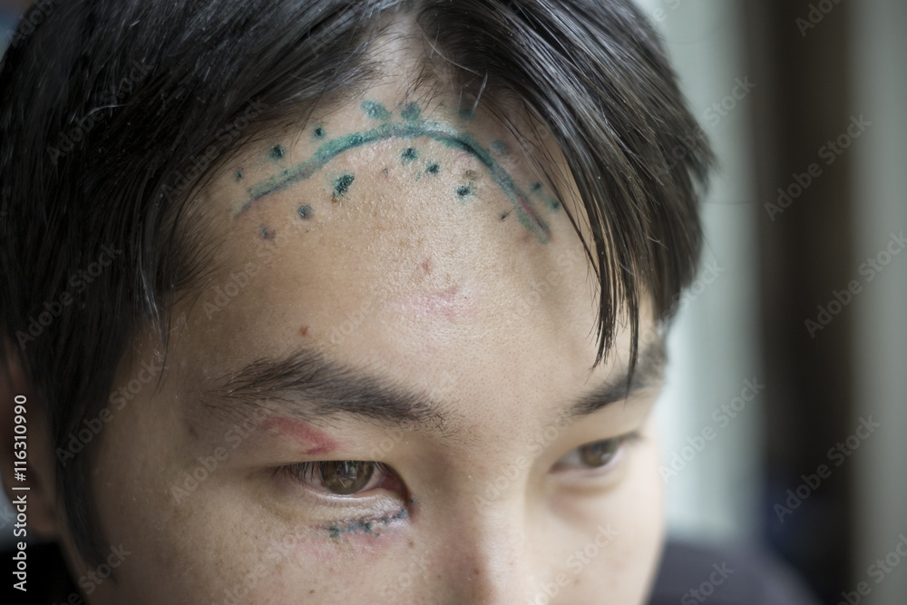 Scar on the head Stock Photo | Adobe Stock