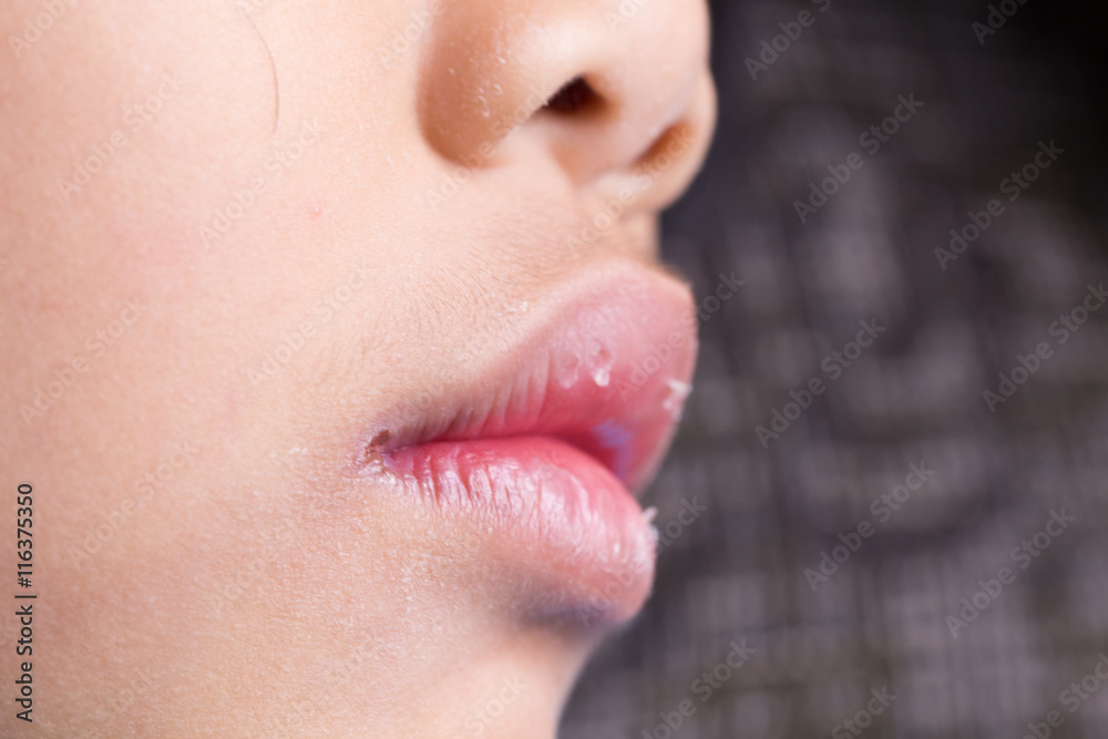 Angular cheilitis.Inflammation of corner mouth. Lack of vitamins Stock ...