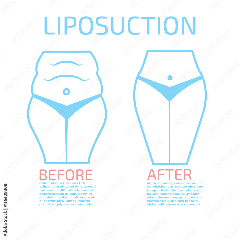 Liposuction before and after infographics Stock Vector | Adobe Stock