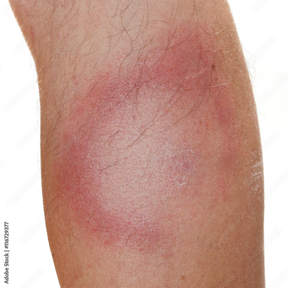 An Erythema Migrans rash often seen in the early stage of Lyme disease ...