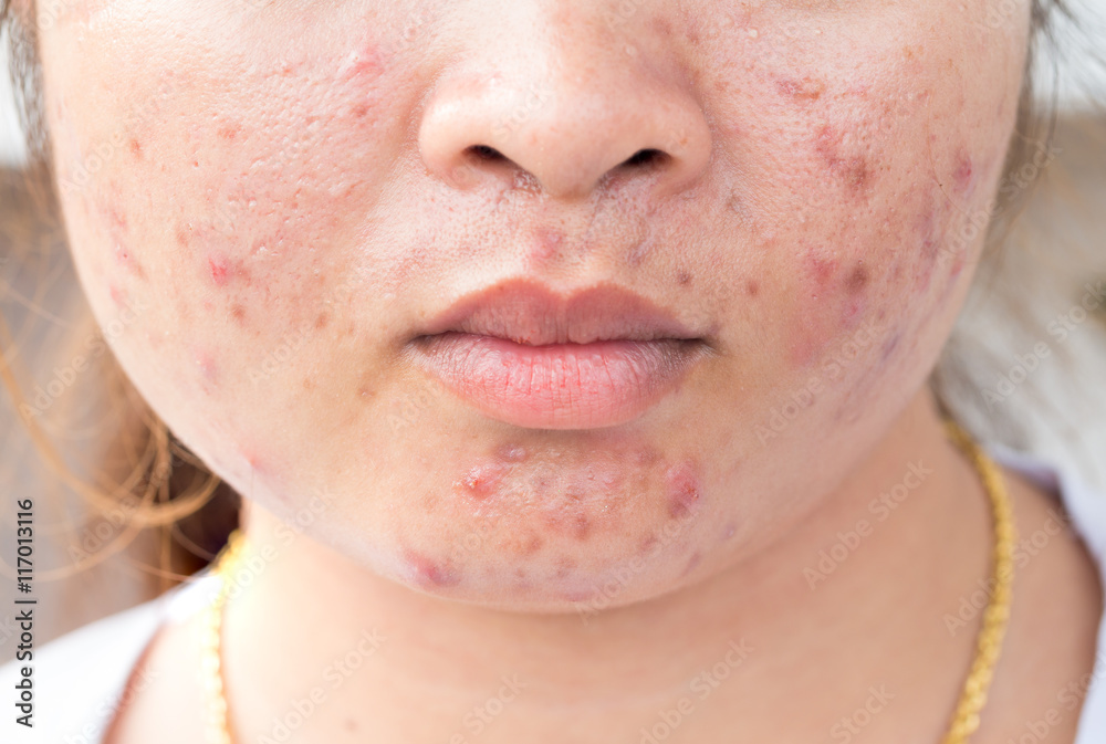 Girl with problematic skin and scars from acne (scar) Stock Photo ...