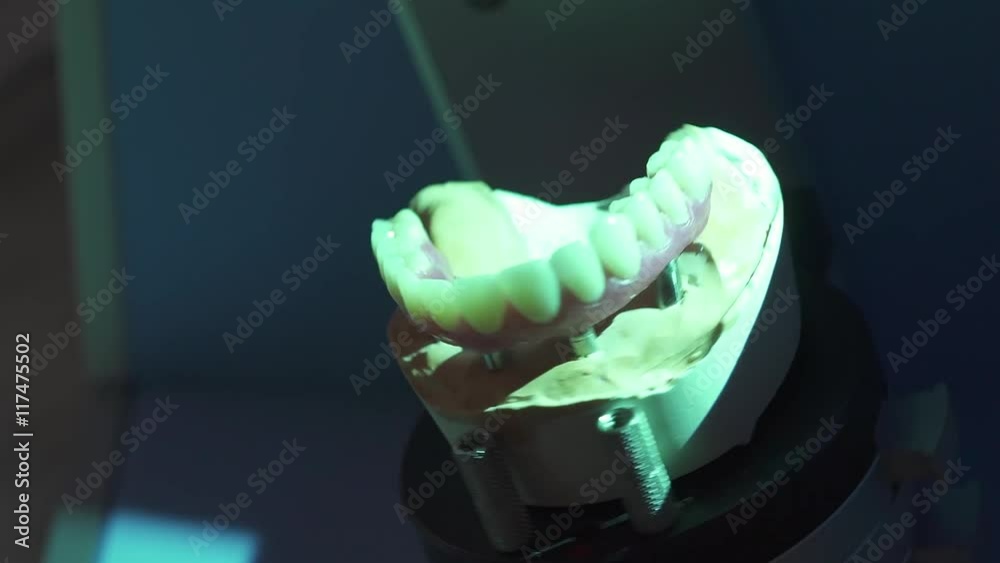 Dental prosthetic restoration. Denturist is making 3D model for ...