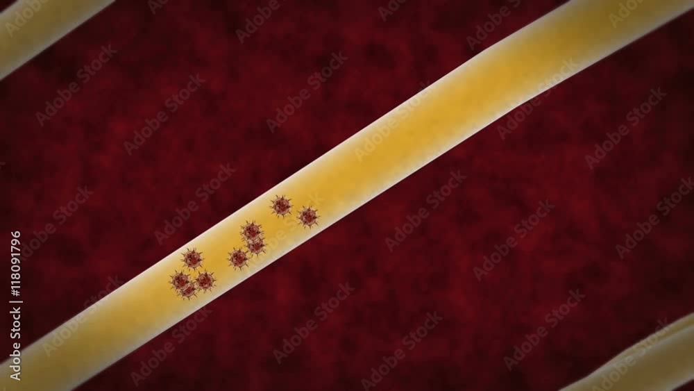 Video Stock The shingles virus activates in older people with weak ...