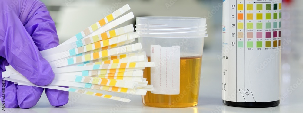 Urinprobe im Labor mit Urinteststreifen Stock Photo | Adobe Stock