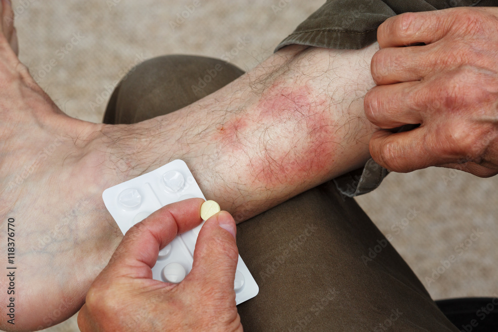 Symptom of Lyme Disease, Circular Expanding Rash, Erythema Migra Stock ...