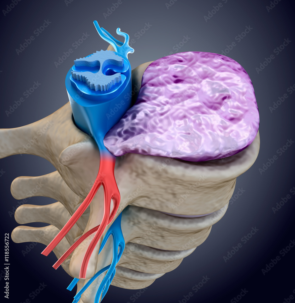 Spinal cord under pressure of bulging disc. Medically accurate 3D ...