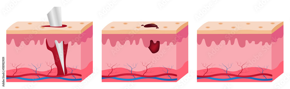 wound skin vector graphic . blood come out of wound Stock Vector ...