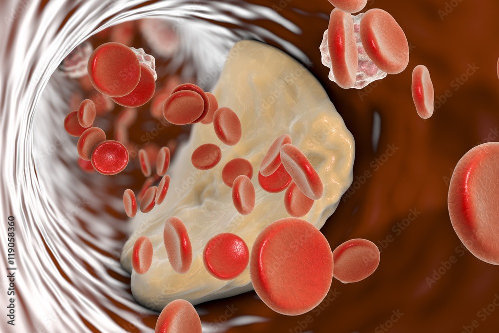 Atheroma plaque inside artery. 3D illustration which can be used for ...