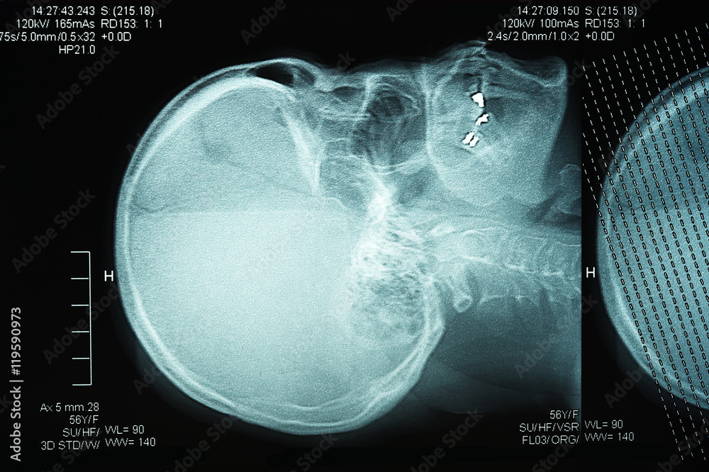 Profile view with a human skull X Ray on black background Stock Photo ...