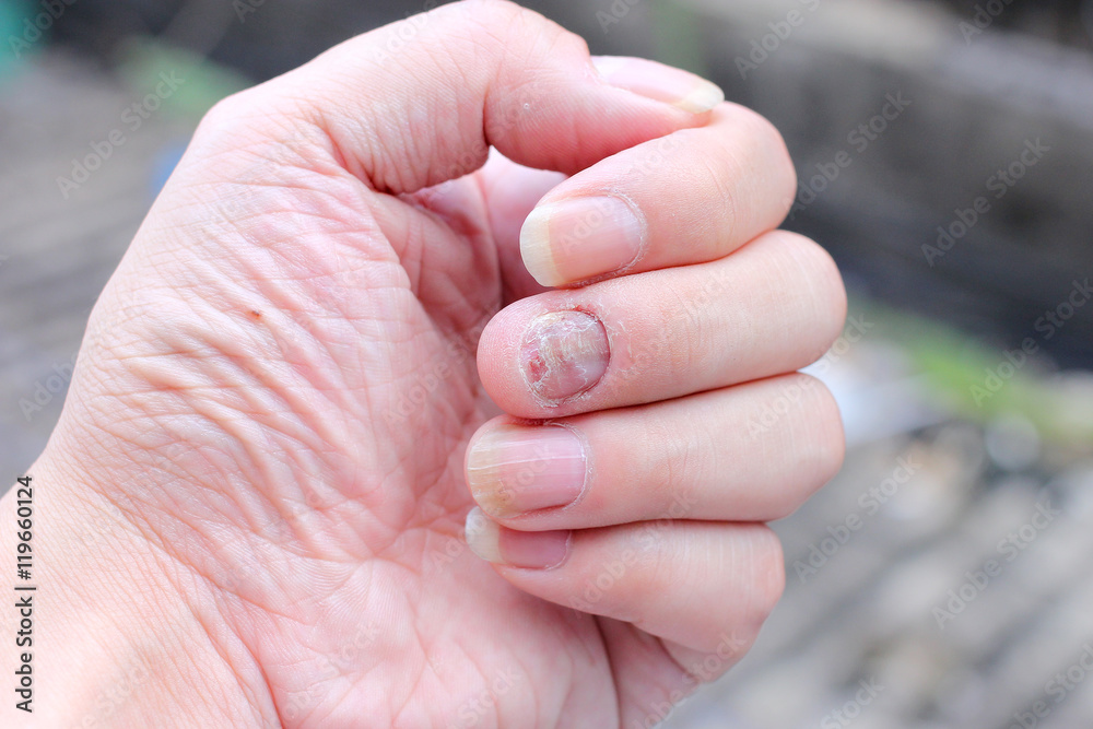 Fungus Infection on Nails Hand, Finger with onychomycosis. - soft focus ...