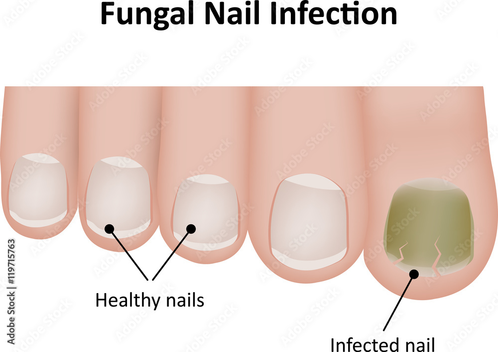 Fungal Nail Infection Diagram Stock Illustration | Adobe Stock