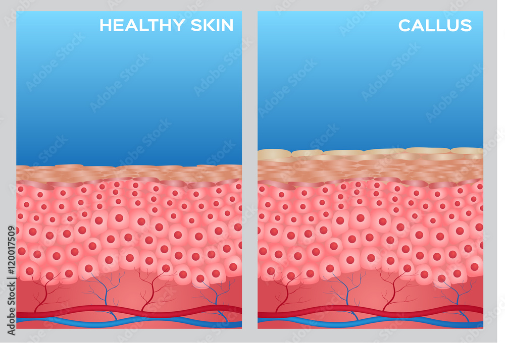 callus skin anatomy and healthy skin Stock Vector | Adobe Stock