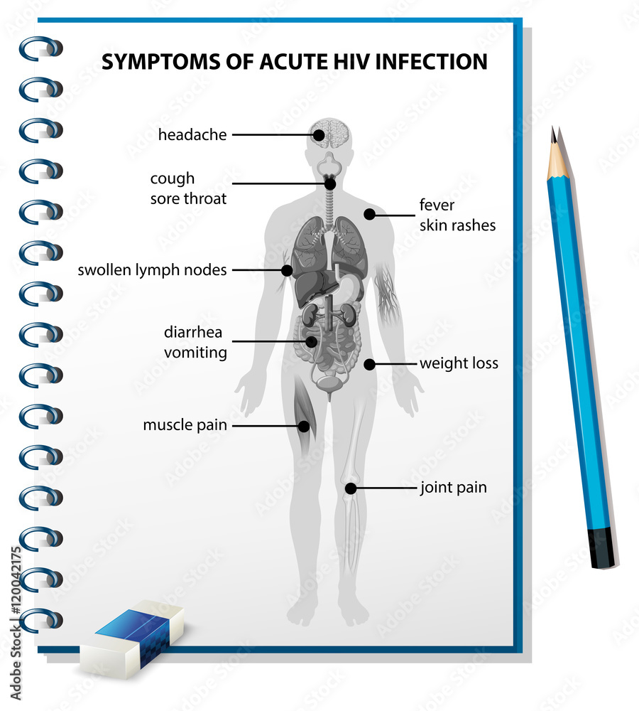 Symptoms of acute HIV infection diagram Stock Vector | Adobe Stock