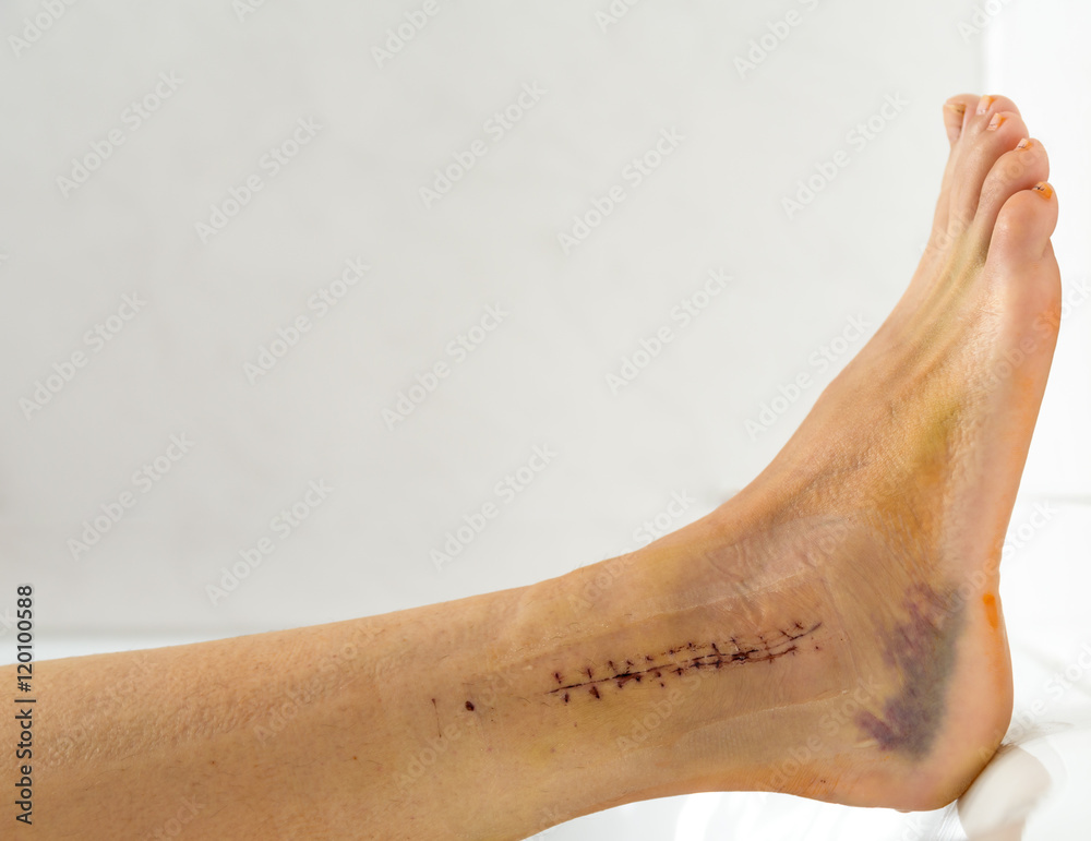 Fraktur des Wadenbeins - gebrochenes Bein Stock-Foto | Adobe Stock