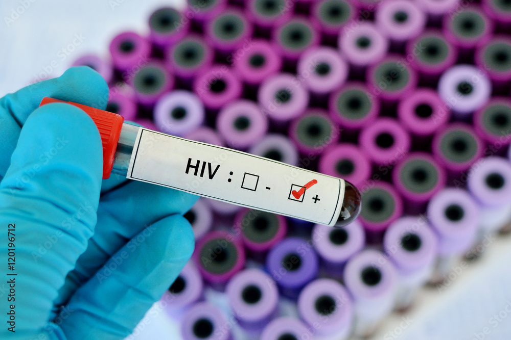 Blood sample positive with HIV test Stock Photo | Adobe Stock