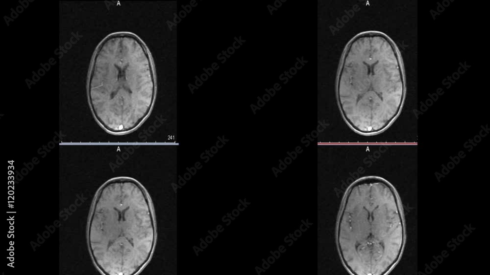 Magnetic resonance imaging of the brain sclerosis microstroke white ...