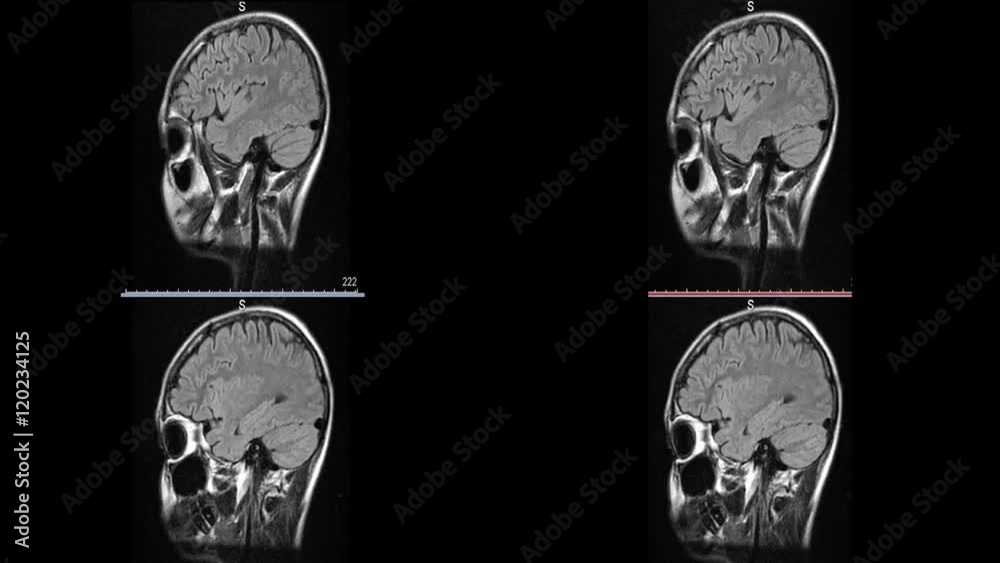 Magnetic resonance imaging of brain sclerosis microstroke white spots ...